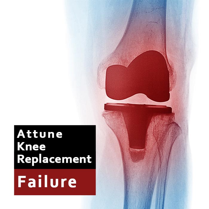 attune-knee-replacement-failure-lawsuit